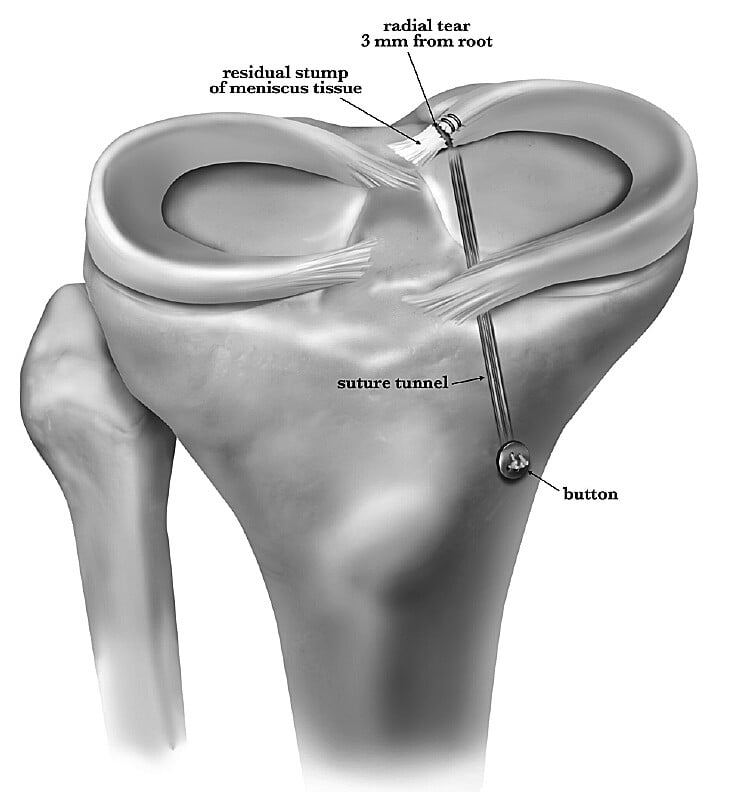 Meniscus Root Tear Knee Doctor Baton Rouge LA Meniscus Root Tear Knee Doctor Baton Rouge LA