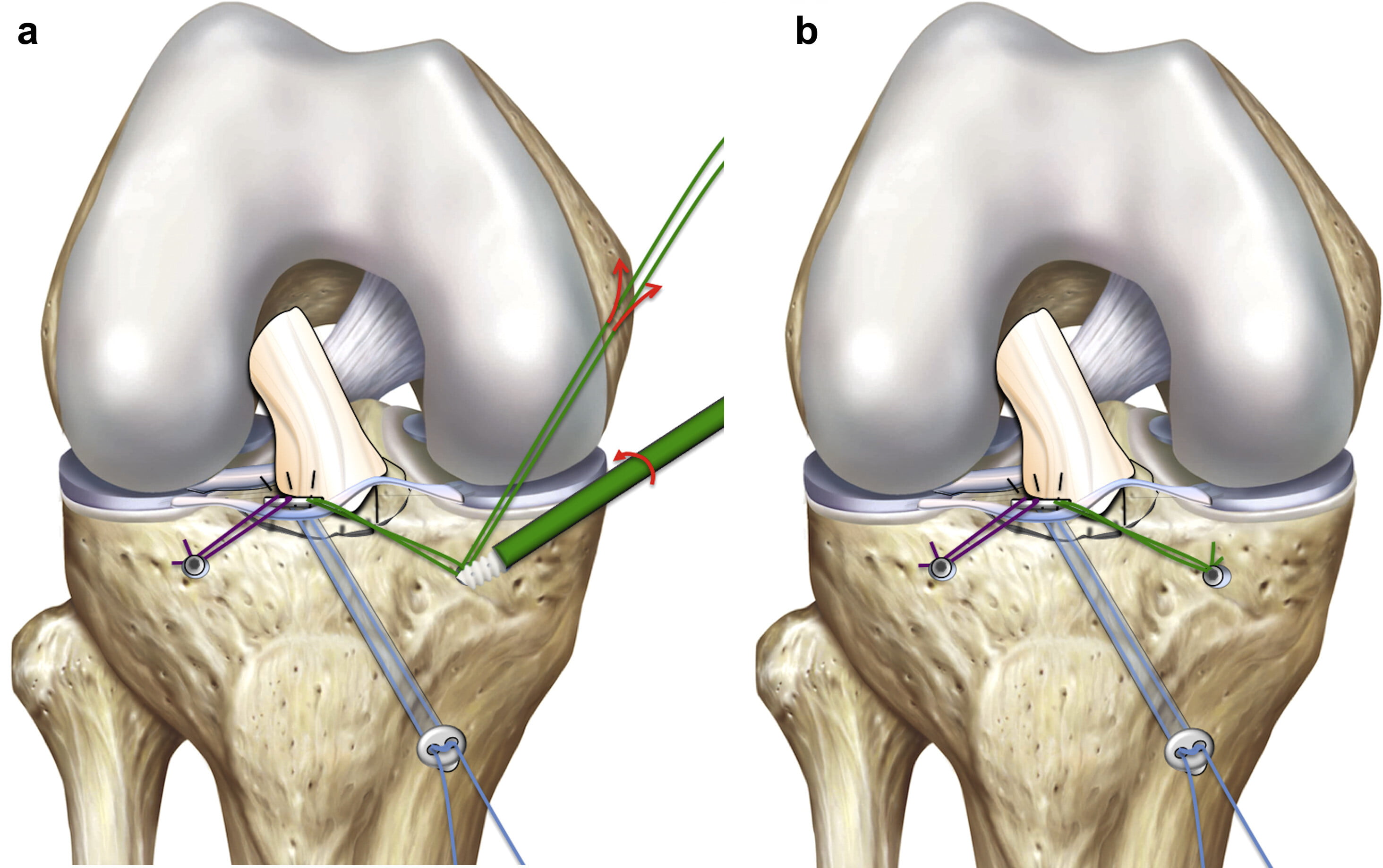Pediatric Adolescent Tibial Eminence Fracture Jeremy M Burnham MD Pediatric Adolescent Tibial Eminence Fracture Jeremy M Burnham MD