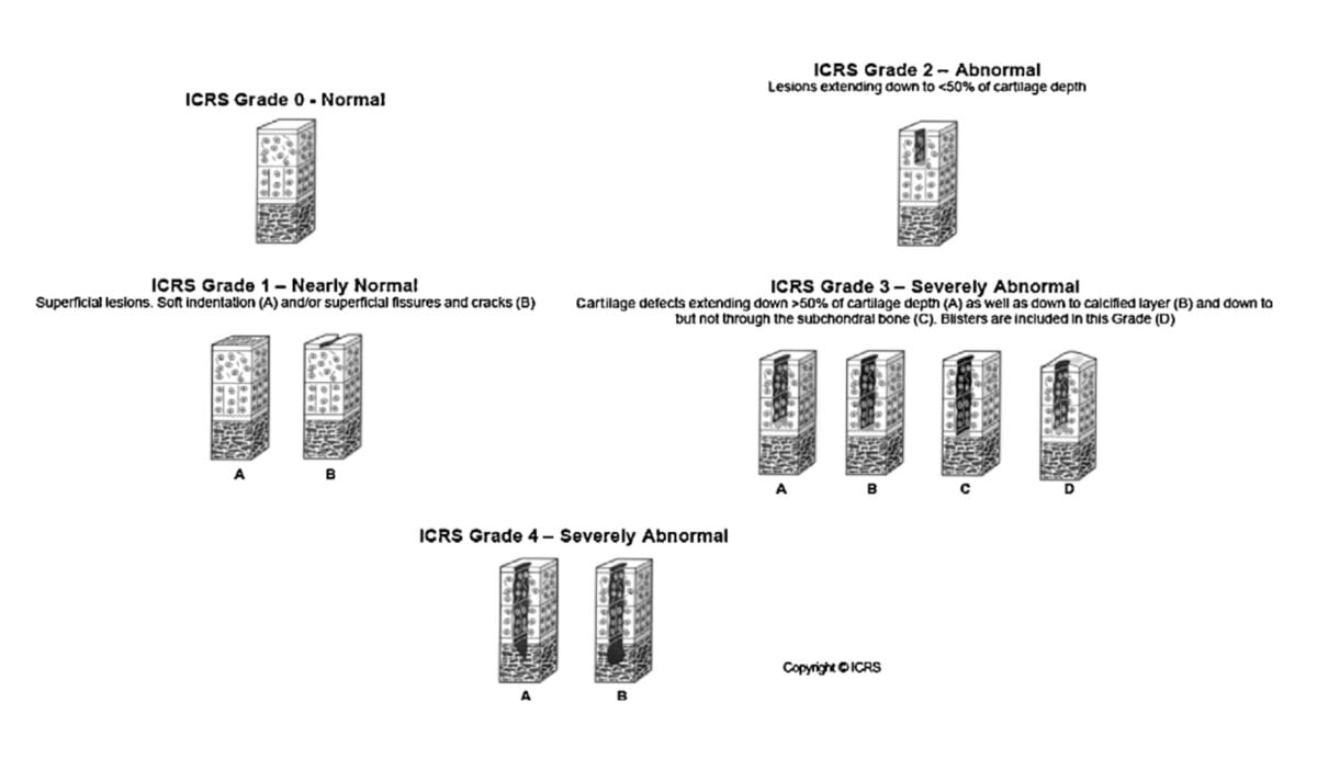 Cartilage Restoration & Repair | Jeremy Burnham, MD - Knee Specialist