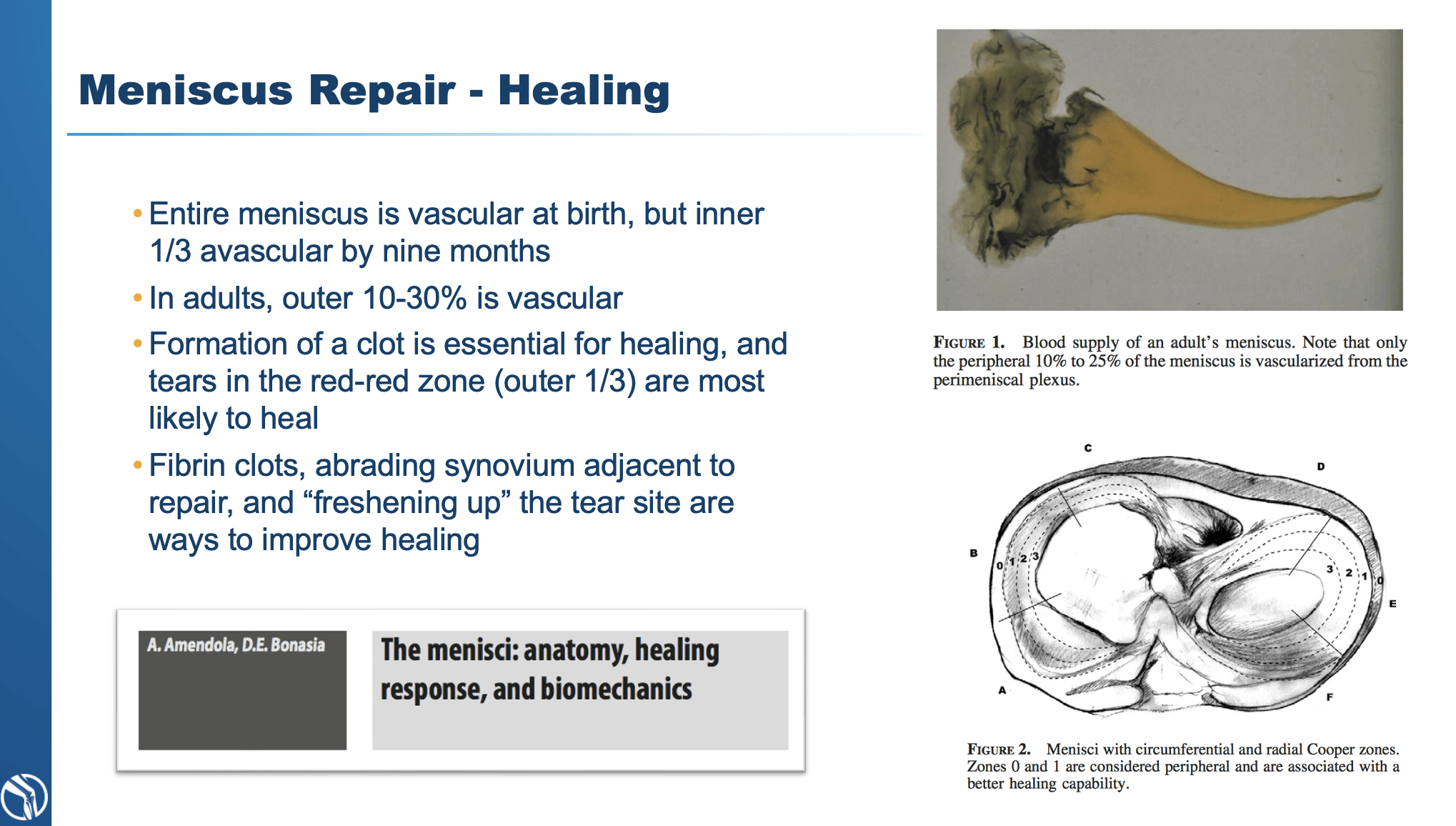3 Types Of Meniscus Tear Treatment Knee Specialist Baton Rouge LA 3 Types Of Meniscus Tear Treatment Knee Specialist Baton Rouge LA