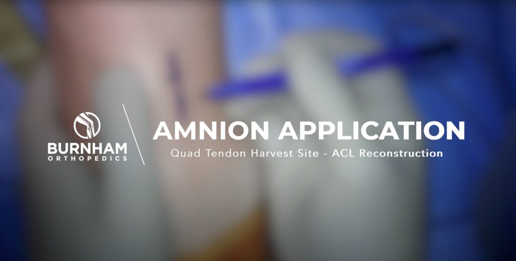 Amnion Application to the Quad Tendon Harvest Site During Quad Tendon ...