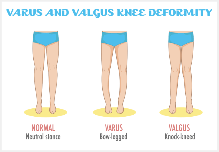 Knock Knees (Genu Valgum): Causes, When to Worry, and Treatment